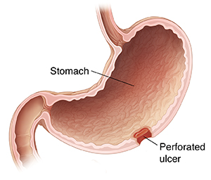 Understanding Perforated Ulcers | YourCareEverywhere