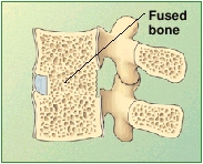 Spinal Fusion: Posterior Lumbar | YourCareEverywhere