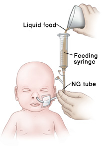Your Child’s Nasogastric Tube: A Comprehensive Guide to Care ...