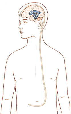 Discharge Instructions for Hydrocephalus (Pediatric) | YourCareEverywhere