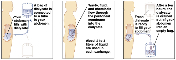 Peritoneal Dialysis (PD) | YourCareEverywhere
