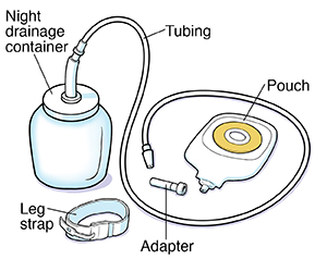Urostomy: Using a Night Drainage System | YourCareEverywhere