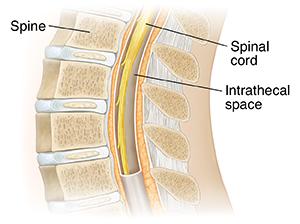 Understanding an Intrathecal Pain Pump Implant | YourCareEverywhere