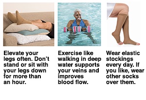 Understanding Chronic Venous Insufficiency | YourCareEverywhere