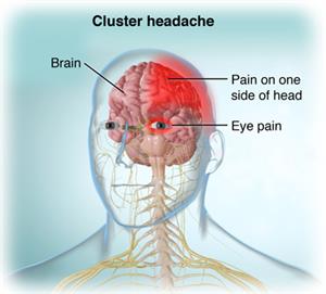 Cluster Headaches | Cedars-Sinai
