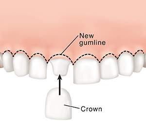 Crown Lengthening Surgery | Saint Luke's Health System