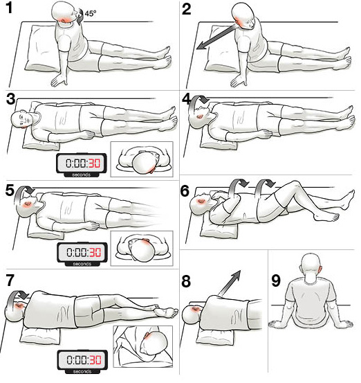 Epley Maneuver Illustration