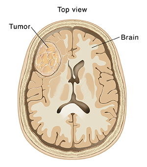 Brain Tumors | Saint Luke's Health System