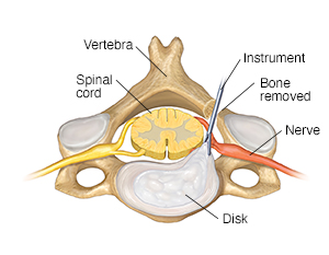 During Cervical Disk Surgery | Saint Luke's Health System