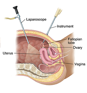 Laparoscopic Scope