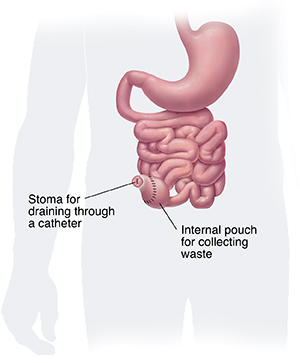 Cateter Intestinal Permanente Navigating Your Bowel Cancer Diagnosis