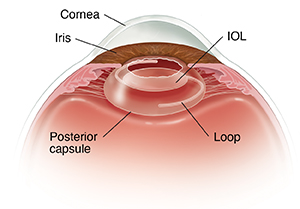 Cataract Treatment: Implanting a New Lens (IOL) | Saint Luke's Health ...