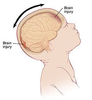 Preventing Abusive Head Trauma | Saint Luke's Health System