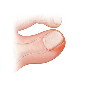 Understanding Ingrown Toenails | Saint Luke's Health System