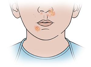 When Your Child Has Impetigo | Saint Luke's Health System