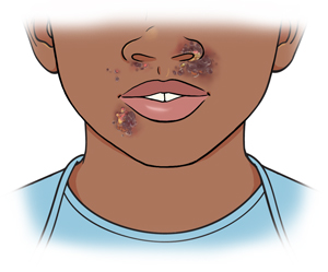 When Your Child Has Impetigo | Saint Luke's Health System