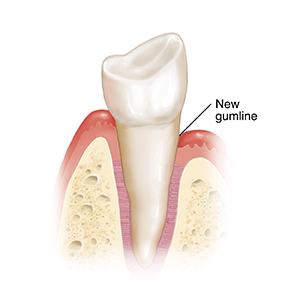 Periodontal Disease: Pocket Reduction Surgery | Saint Luke's Health System