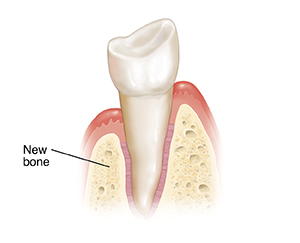 Periodontal Disease: Bone Replacement Graft | Saint Luke's Health System