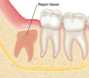 Normal Wisdom Teeth Wisdom Teeth – Dr. Herman Tong