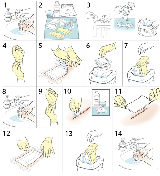 Step by Step Changing A Wound Dressing Saint Luke s Health System