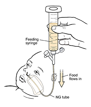 Your Child's Nasogastric Tube: Syringe Feeding | Saint Luke's Health System