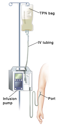 Discharge Instructions: Total Parenteral Nutrition (TPN) for Your Child ...
