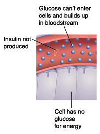 Diabetes and Your Child: Understanding Type 1 | Saint Luke's Health System