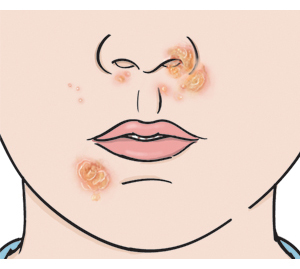 When Your Child Has Impetigo | Saint Luke's Health System