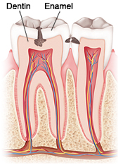 Understanding Tooth Decay | Saint Luke's Health System