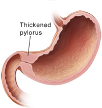Infantile Hypertrophic Pyloric Stenosis Image Radiopaediaorg