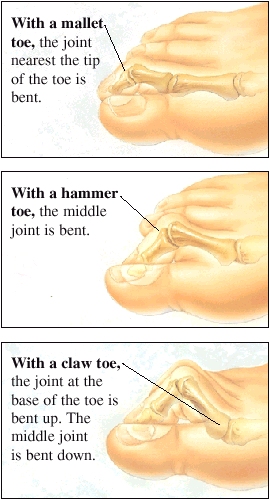 What Are Mallet Hammer And Claw Toes Saint Lukes Health System
