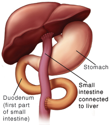 Treatment for Your Child’s Biliary Atresia: Kasai Procedure | Saint Luke's Health System