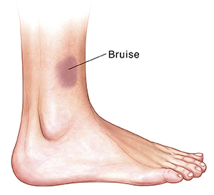 Permanent Bruise On Foot Online | emergencydentistry.com