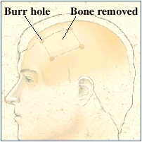 The Day of Your Craniotomy | Saint Luke's Health System